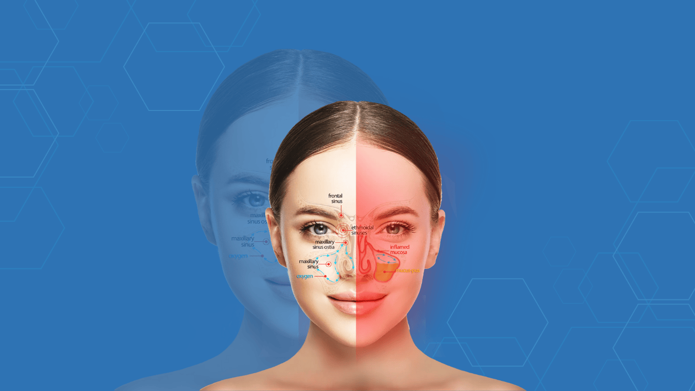 CILIACELL: Innovative Treatment for Purulent Infectious Sinusitis and ...